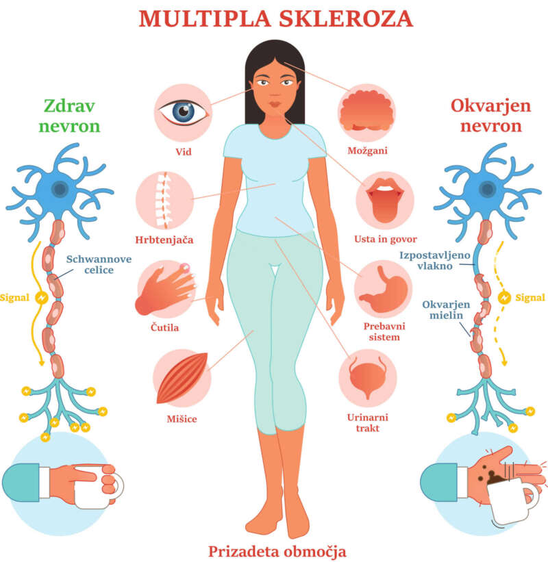 Simptomi multiple skleroze - Združenje multiple skleroze Slovenije
